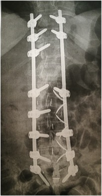 Déformations Rachidiennes (scoliose, cyphose) - Institut de Chirurgie ...